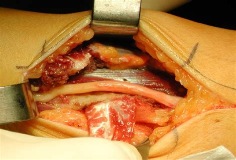 Ulnar Nerve Transposition Download Scientific Diagram