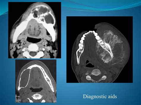 Reconstruction Of Mandibular Defects Pptx