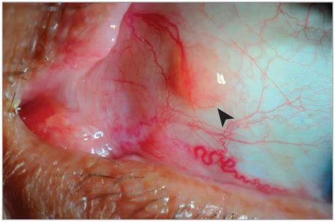 Conjunctival Nodule In A Female With Ulcerative Colitis Ama Ed Hub