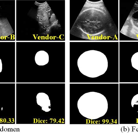 Illustration Of Segmentation Degradation On A Fetal Abdomen And B