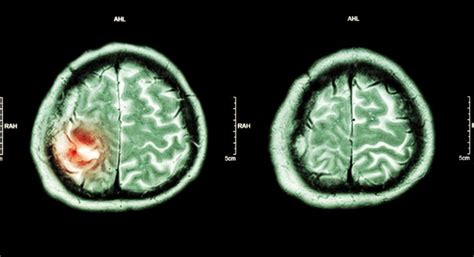 Jenis Jenis Stroke Kortex