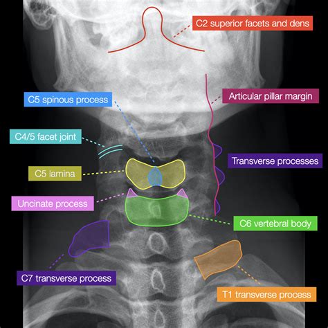 Cervical Spine X Ray Results At Maddison Pickworth Blog