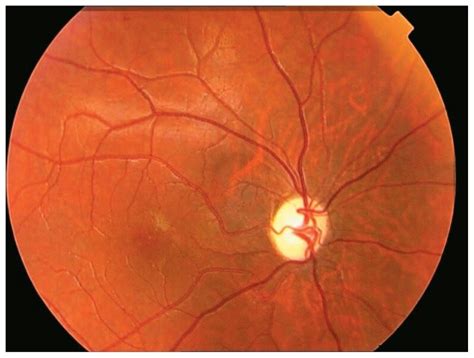 Optic Atrophy In The Right Eye Download Scientific Diagram