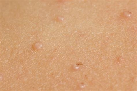 Molluscum Contagiosum Pictures Stages Symptoms And Causes
