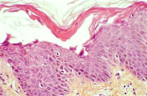 Ssss A Clinical Appearance Of Ssss With Nikolsky Sign B Hematein