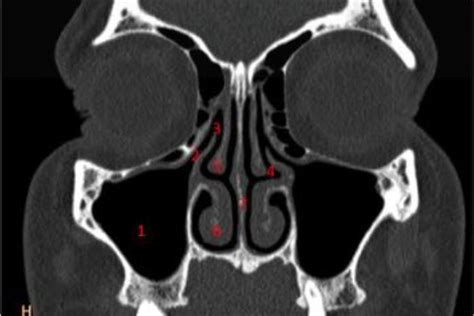 Anatomía Del Seno Etmoidal