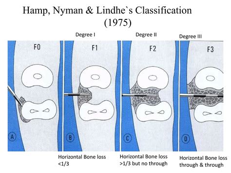 Bone Defects In Different Periodontal Diseasepptx