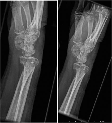 Distal Radioulnar Joint Subluxation
