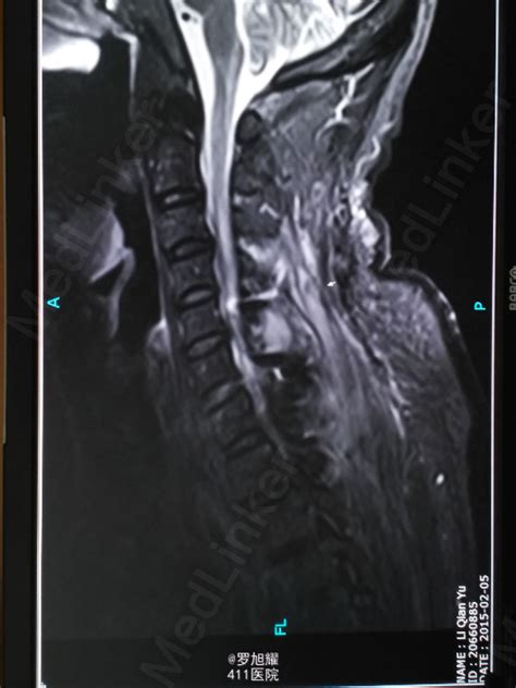 颈椎高位截瘫颈椎骨折高位截瘫儿童大山谷图库