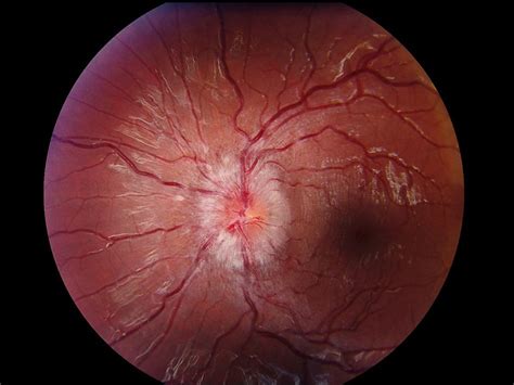How To Grade Papilledema