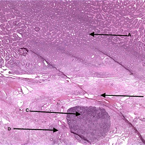 Pathology Slide Demonstrating Invasion Of The Duodenum By Immature