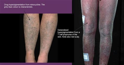 Dermatology Made Simple Hyperpigmentation Generalised Dermatology Made Simple Hyperpigmentation Generalised