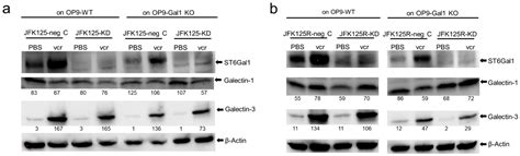 Galectin 1 And Galectin 3 In B Cell Precursor Acute Lymphoblastic Leukemia