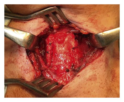 Findings Of Thyroid Cartilage At The End Of Surgery The Right Was Download Scientific Diagram