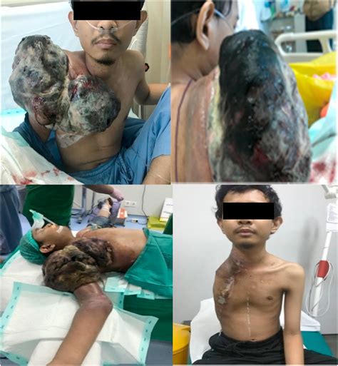 Preoperative Intraoperative And Postoperative Of Forequarter Amputation Download Scientific