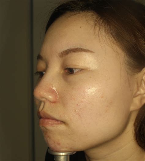 Acne04 Object Detection Model V1 2023 01 30 12 23pm By Andrei Dore