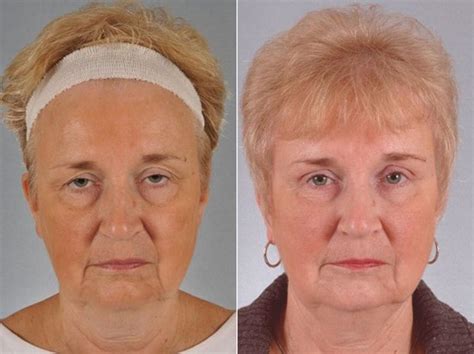 Patient 349525 Droopy Eyelids Ptosis Before And After Photos W