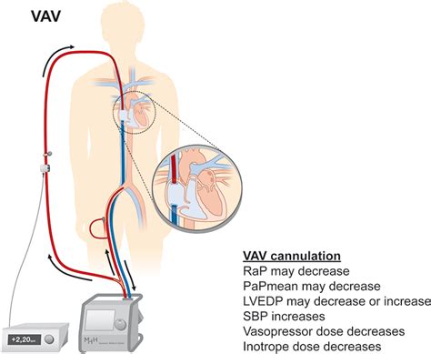 Triple Cannulation Ecmo Intechopen