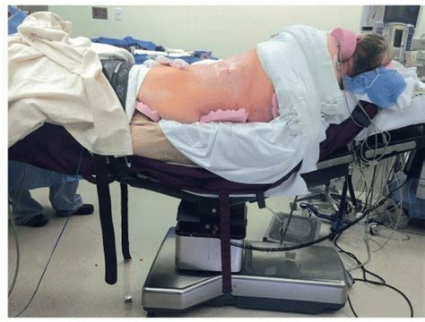 Hernia Repair With Open Component Separation Plastic Surgery Key