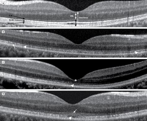 Multimodal Imaging Of Occult Macular Dystrophy Ophthalmic Imaging Jama Ophthalmology The