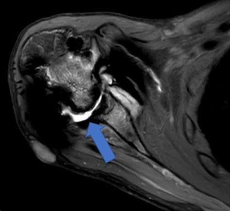 Shadows Of The Bleeding Joint A Radiologic Exploration Radiology Key