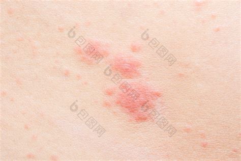 疮疹高清图片下载 疮疹图片 疮疹素材 包图网企业站
