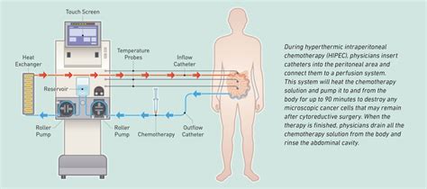 Peritoneal Surface Malignancies Physician Resources Fox Chase