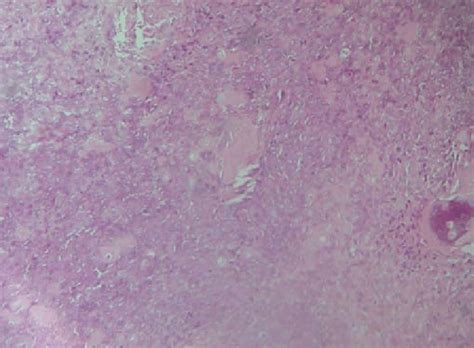 Histopathology Revealing Highly Cellular Connective Tissue Stroma With Download Scientific