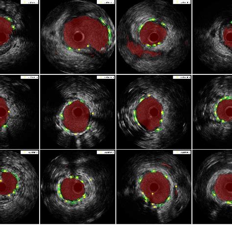 Examples Of Strut Detection In Ivus Images Where The Automatic