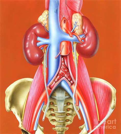 Saddle Embolus At Aortic Bifurcation Photograph By John Bavosiscience Photo Library Pixels