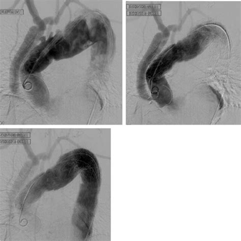 Ct Aortic Angiogram A Type B Aortic Dissection Extending To The