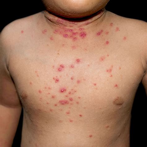 Molluscum Contagiosum Treat It Naturally