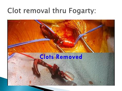 Arterial And Venous Embolectomy Pptx
