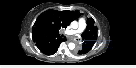 Ct Scan Of The Chest Showing Adenopathy And Soft Tissue In The Left Download Scientific Diagram