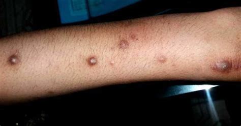 Nodular Prurigo Image