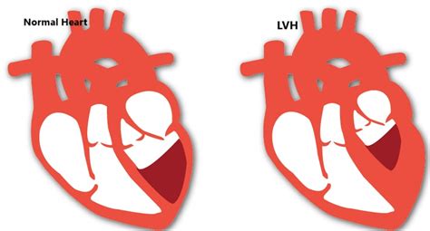 Ventricular Hypertrophy