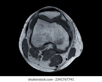 Mri Knee Axial Mri Knee Joint Magnetic Resonance Imaging