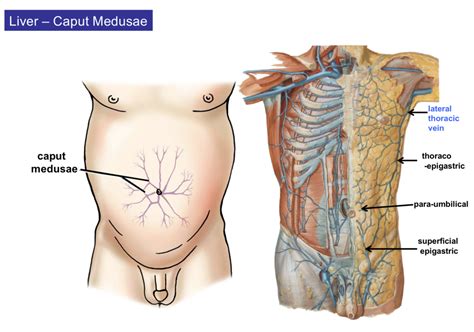 Lecture 12 Diagram Of Liver Caput Medusae Diagram Quizlet