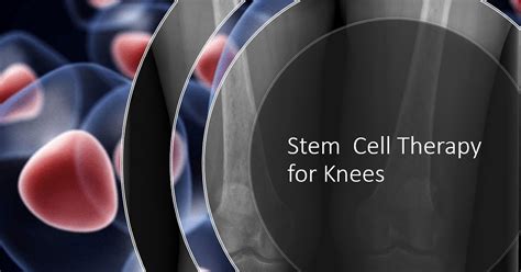 Stem Cell Therapy For Knees Reviews Evidence Effectiveness And Cost