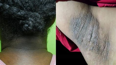 Dark Patches On Skin May Signal Insulin Resistance Early Diabetes Risk