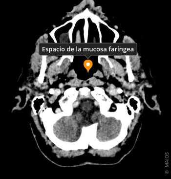 Espacio De La Mucosa Faríngea E Anatomy Imaios