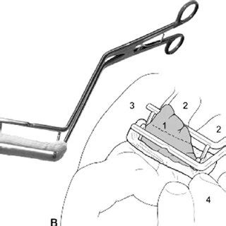Box Lesion Set Patients Either Had A Single Ablation Line Connecting