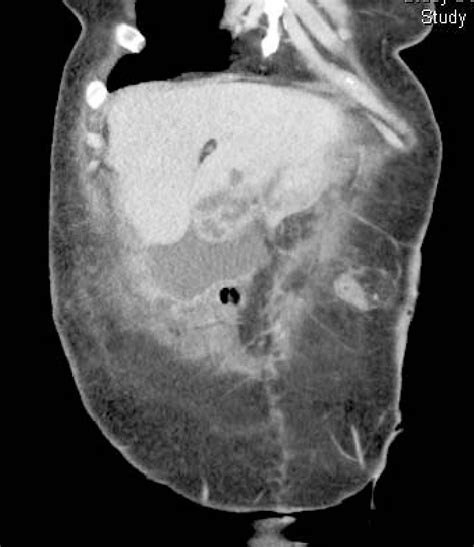 Ct Scan Showing The Bile Leakage And A Left Hepatic Abscess Download
