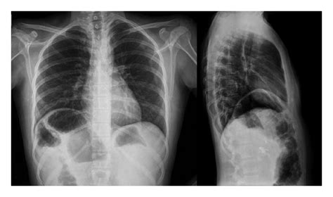 Colonic Interposition Between The Liver And Right Hemidiaphragm
