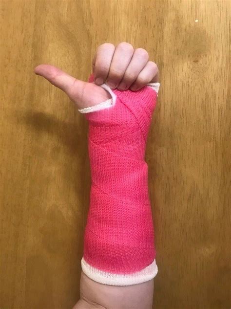 Wrist Fractures Fracture Clinic Royal Cornwall Hospitals Nhs Trust