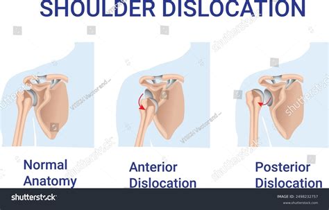 Shoulder Dislocation Normal Anatomy Anterior Dislocation Stock Vector
