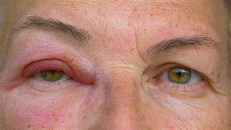 Swollen Eye By Tear Duct At Gene Courtney Blog