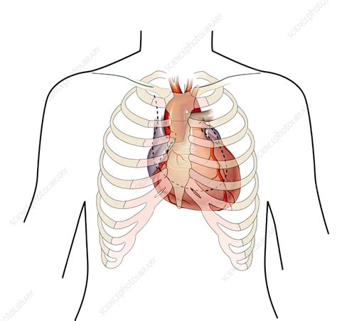 Heart Anatomy With Ribs Cardiomegaly Illustration Stock Image C059 3242 Science Photo