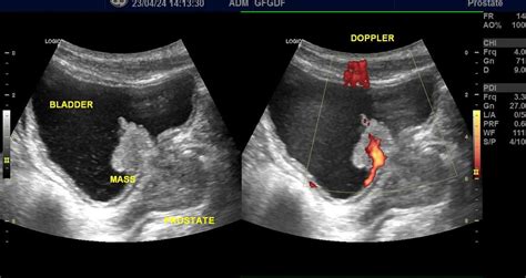 41m Hx Of Polyuria And Pain For 2 Years Us Shows Suspicious