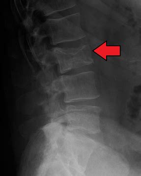Multiple Myeloma Wikipedia